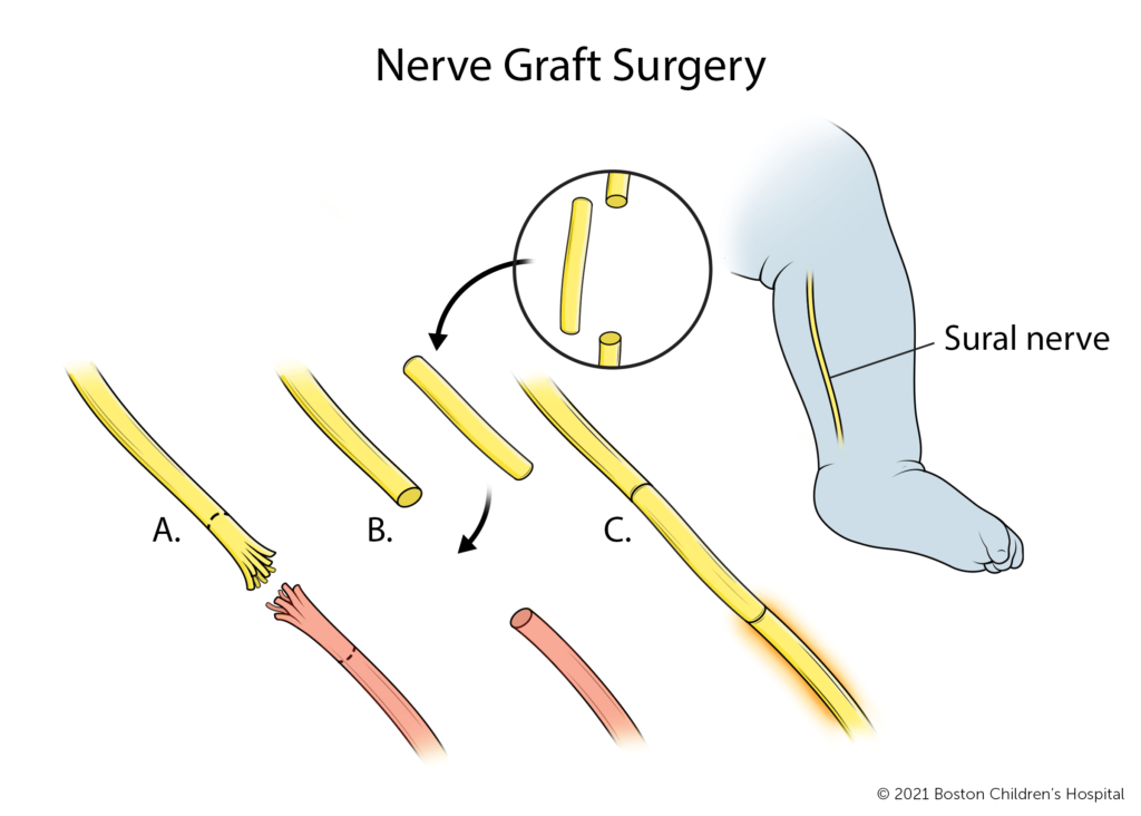 Nerve Grafting Surgery for Erb's Palsy: What You Need to Know - erbspalsy
